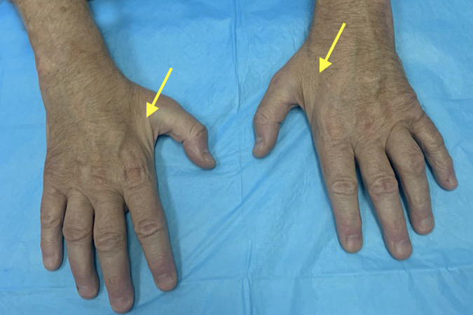 CHARCOT MARIE TOOTH DISEASE | Hand Surgery Resource